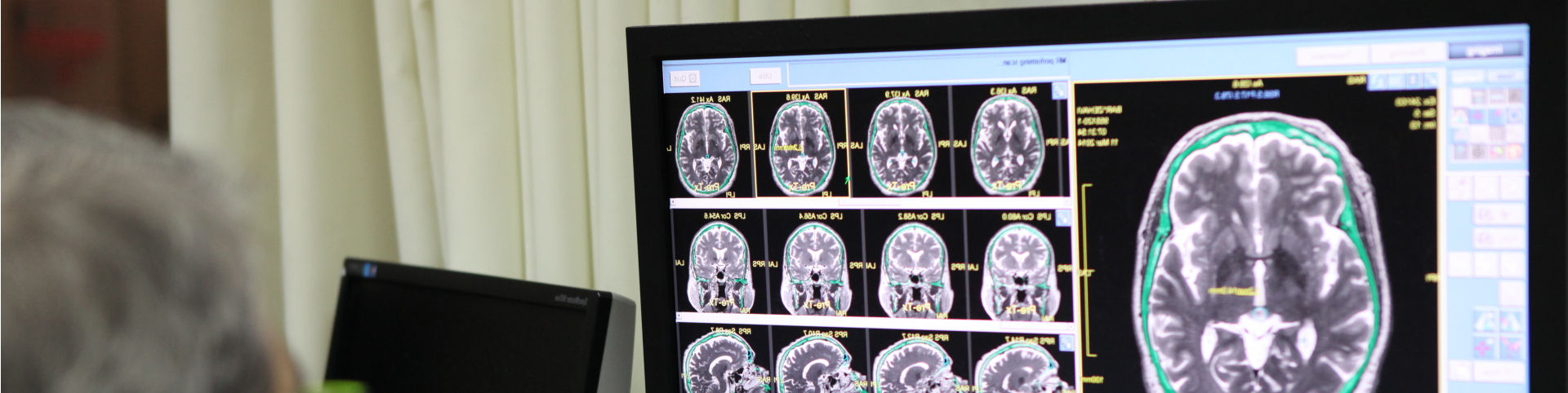 Fucused Ultrasound (FUS) |Essential Tremmor | Parkinson |Rambam HCC